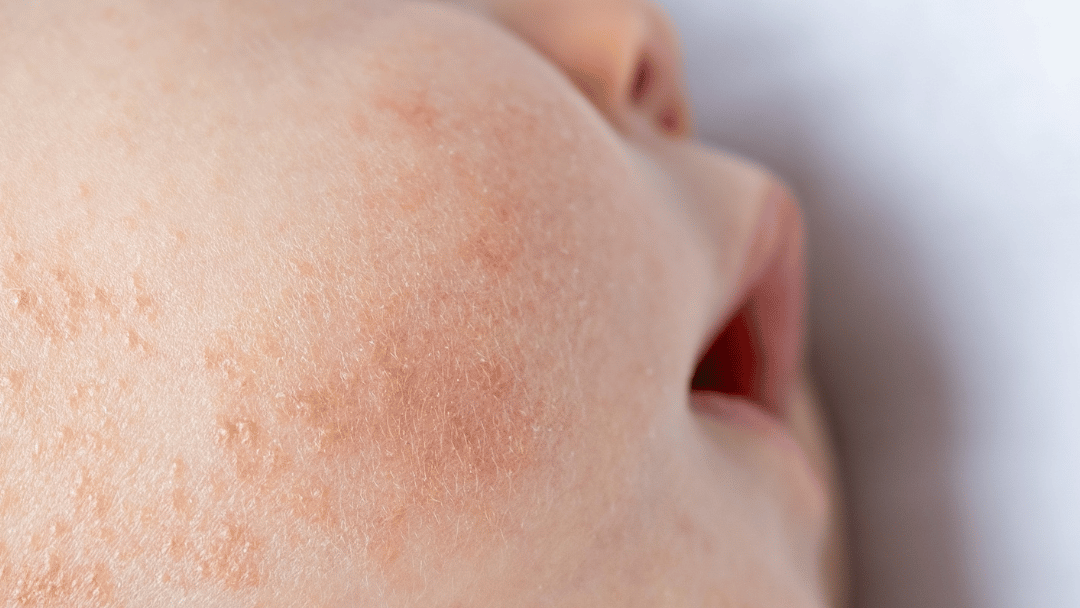 Neurodermitis bei Babys Teil 2: Tipps für den Alltag – KAMI skincare